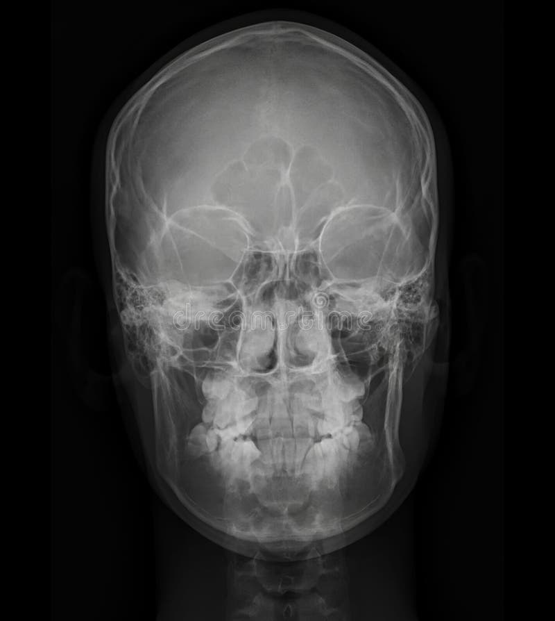 X-ray Image of Human Skull Front View for Diagnosis Skull Fracture ...