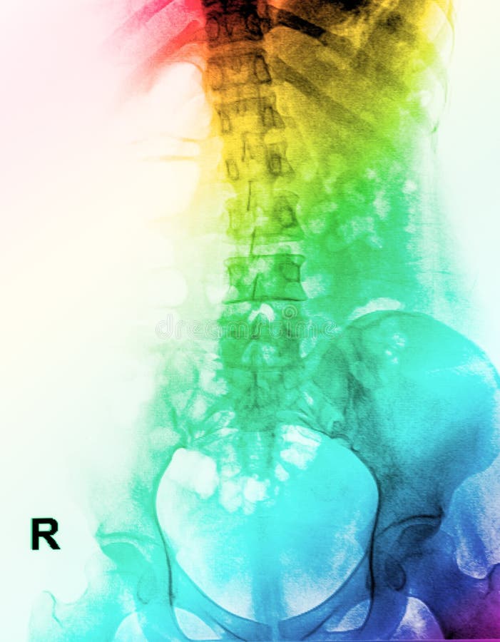 X-ray Image of Human Spinal Column Stock Image - Image of back, spine ...