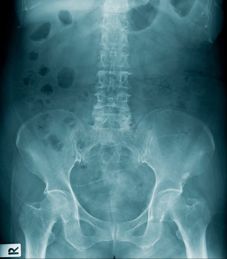 X-ray image of human spine stock image. Image of disc - 148722401