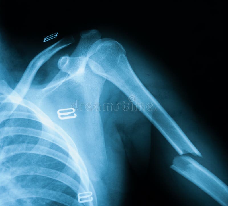 X-ray Image of Humerus Fracture Stock Photo - Image of fracture, joint ...