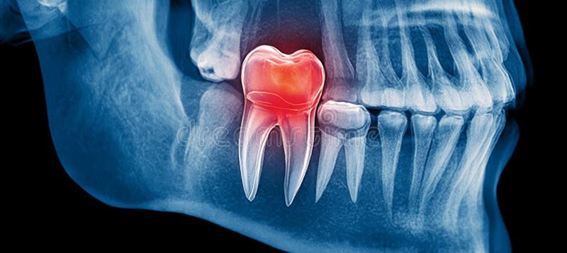 X-ray Image of Impacted Wisdom Tooth Causing Pain and Inflammation ...