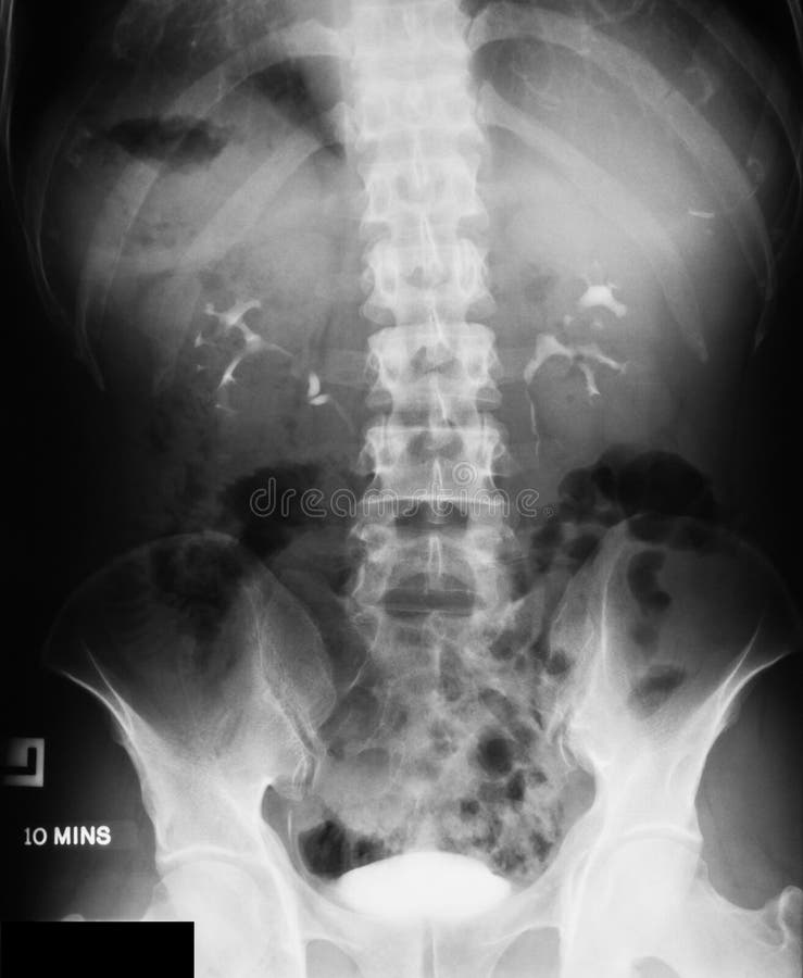 X-ray Image of IVP, Prone Position. Stock Photo - Image of arthritis ...