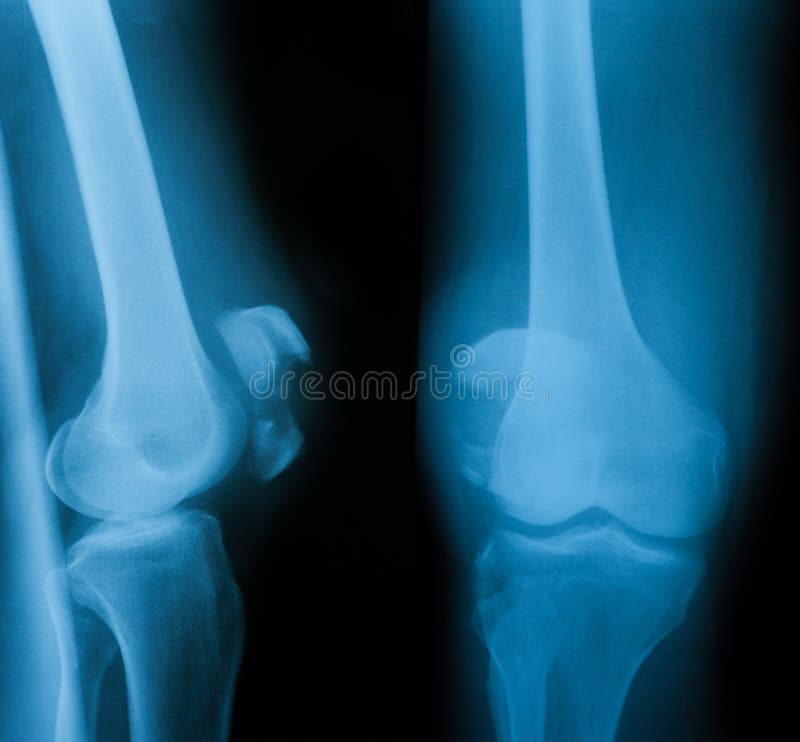 X-ray Image of Knee Joint, AP and Lateral View. Stock Photo - Image of ...