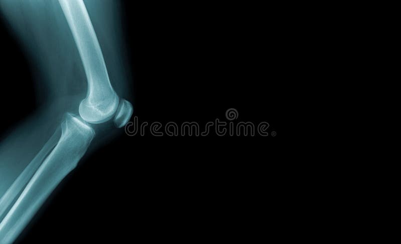 X-ray Image Knee Joint with Banner Design Stock Image - Image of ...