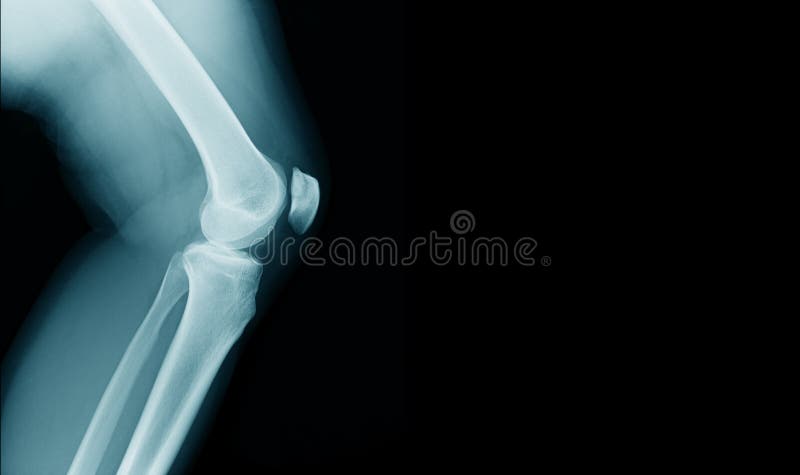 X-ray Image Knee Joint with Banner Design Stock Photo - Image of human ...