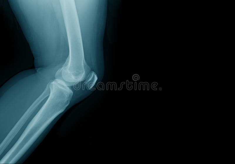 X-ray Image Knee Joint with Banner Stock Image - Image of ...