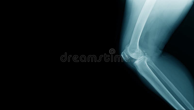 X-ray Image Knee Joint with Banner Design Stock Image - Image of ...