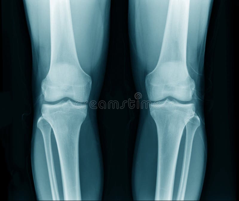 An X-ray Image of a Knee Joint Showing the Bones, Cartilage, and ...