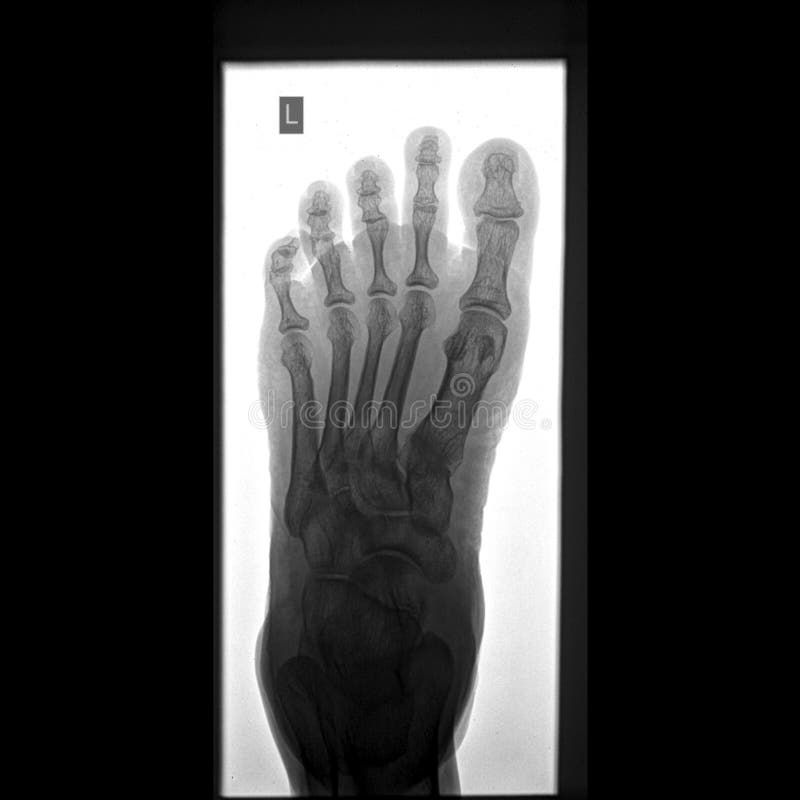 X-ray Image of Left Foot Ap View Stock Image - Image of medical, lower ...