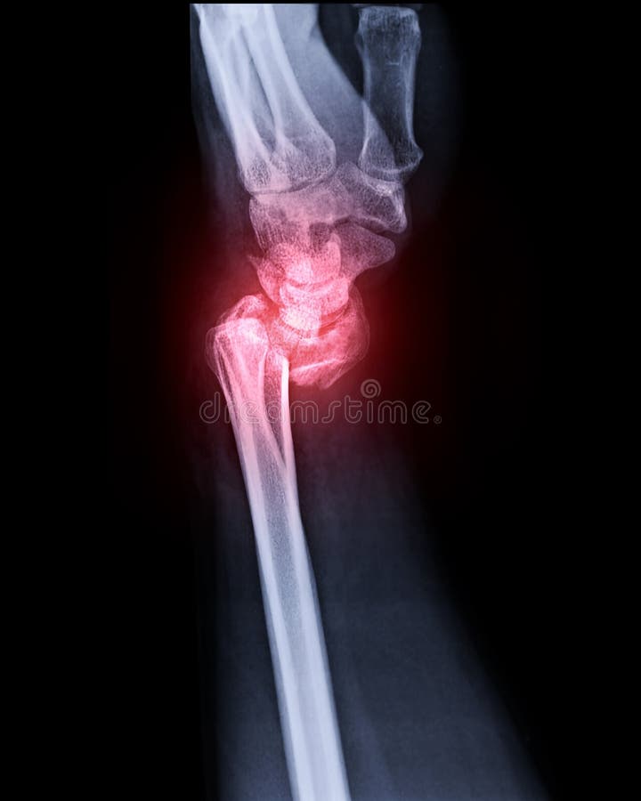 X Ray Wrist Lateral View
