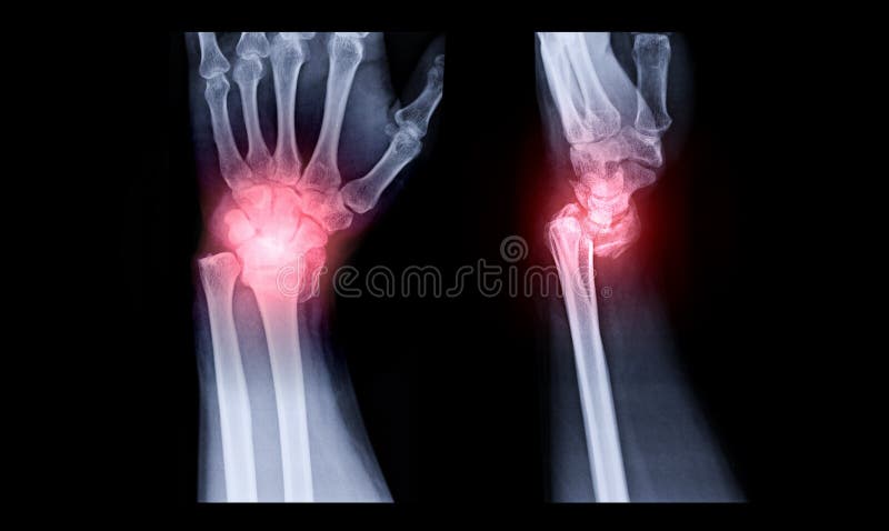 X-ray Image of Left Wrist Joint AP and Lateral View Stock Image - Image ...