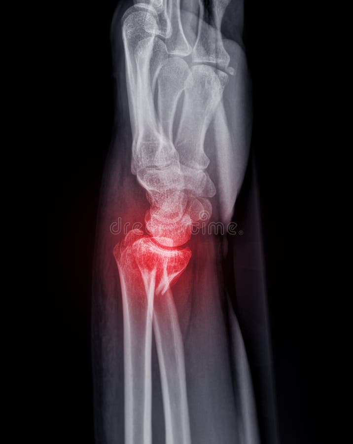 X-ray Image of Left Wrist Joint AP and Lateral View for Showing ...
