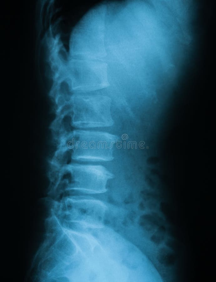 131 Lumbar Spine Ray Lateral Stock Photos - Free & Royalty-Free Stock ...