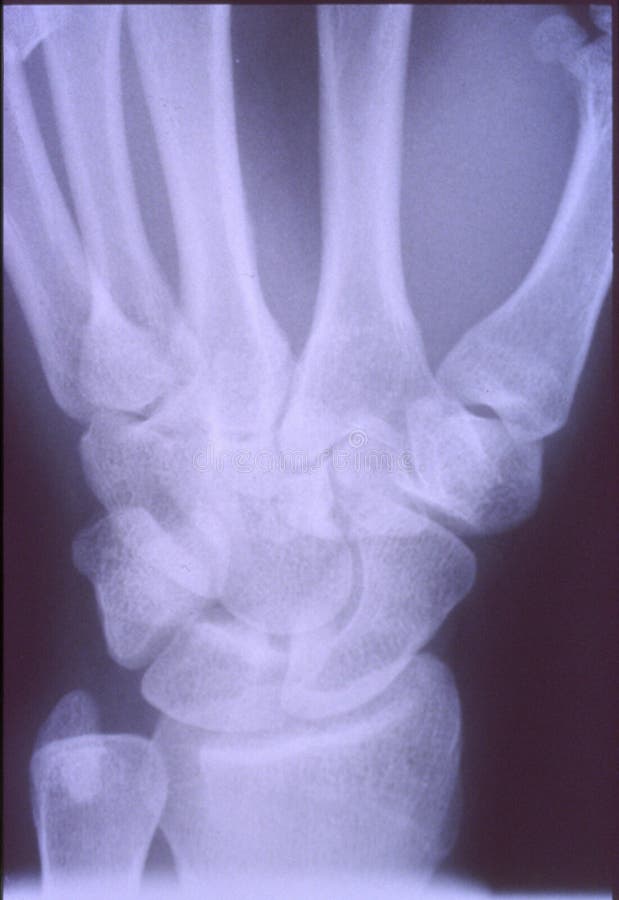 Hand bones injury stock image. Image of metacarpal, inflame - 149137547