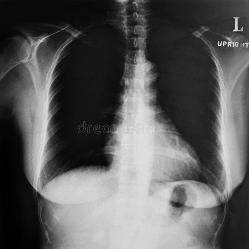Normal Chest X Ray Female