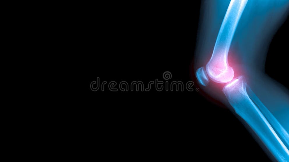 X-ray Image OA with Banner Space Stock Illustration - Illustration of ...