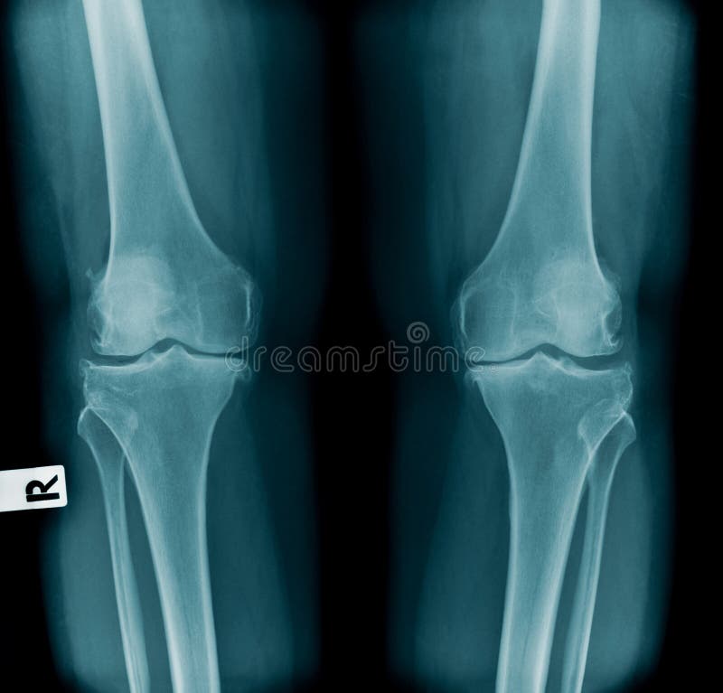 X-ray image OA knee stock photo. Image of bone, disease - 148723002