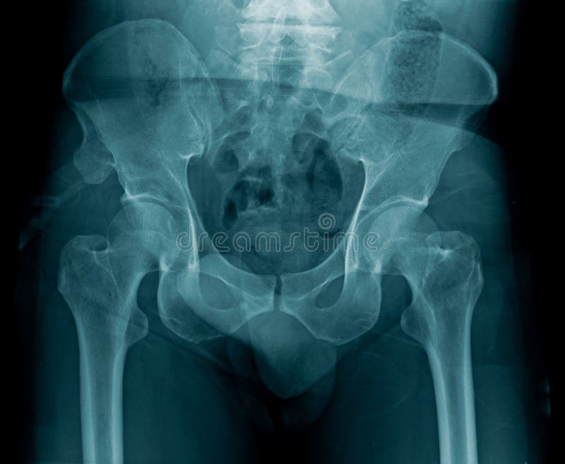 X-ray Image Pelvic Bone and Hip Joint Stock Image - Image of pelvis ...
