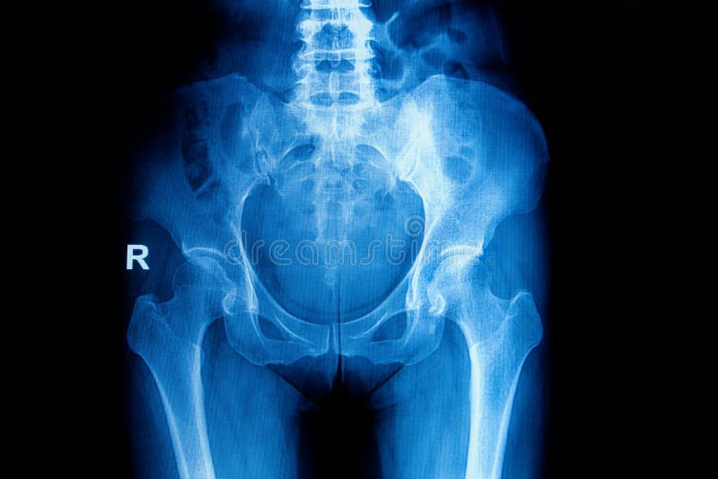 X-ray image pelvis and hip stock image. Image of medical - 39057943