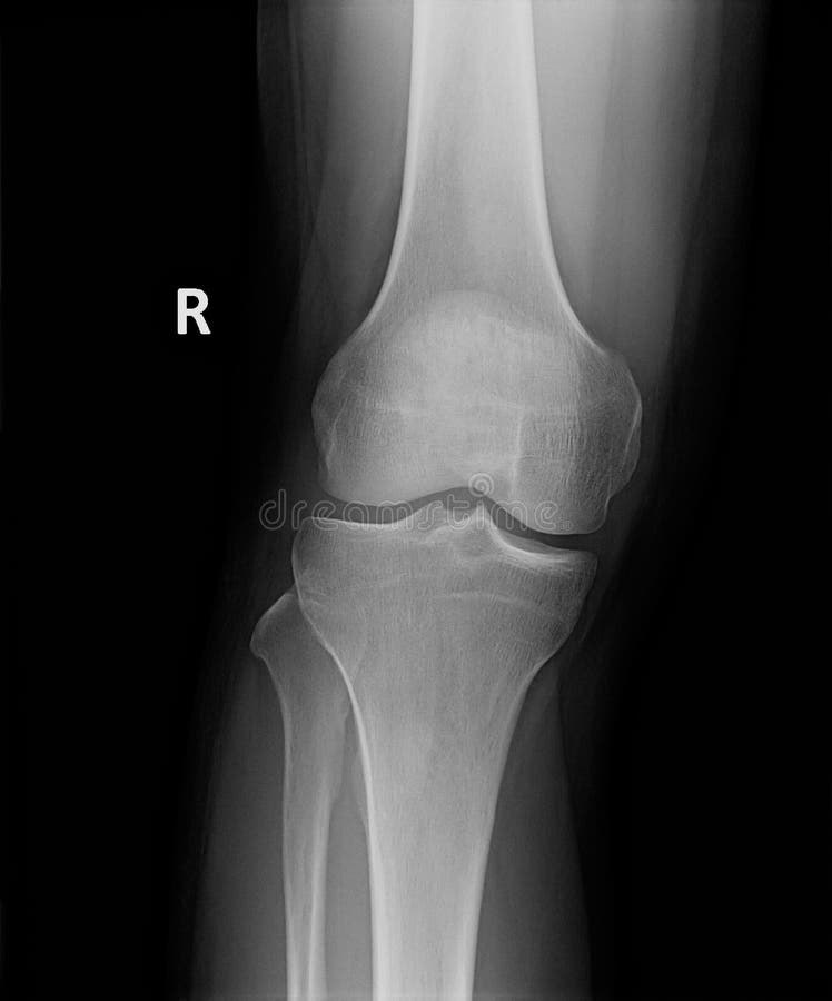 X-Ray Image of Perfect Knee and Leg Stock Photo - Image of bone ...