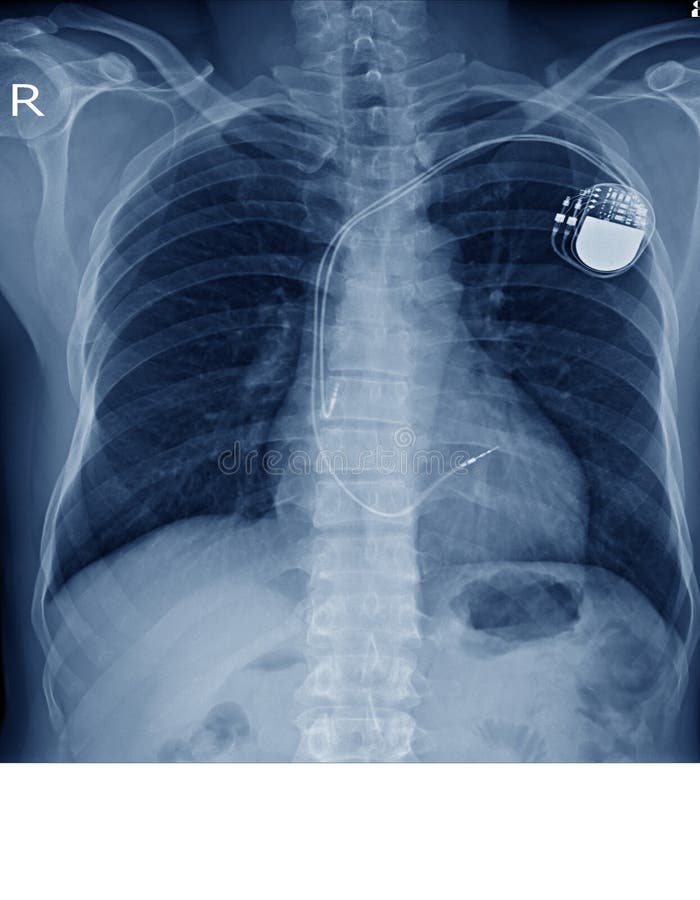 X-ray Image Of Permanent Pacemaker Implant In Chest Body , Process In ...