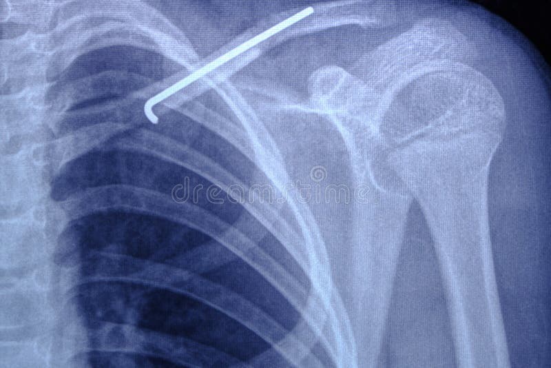 X Ray Image Person with Broken Collarbone and Spoke Installed in it ...