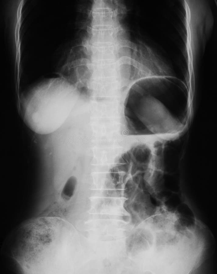 X-ray Image of Plain Abdomen. Stock Image - Image of ileum, abdomen ...