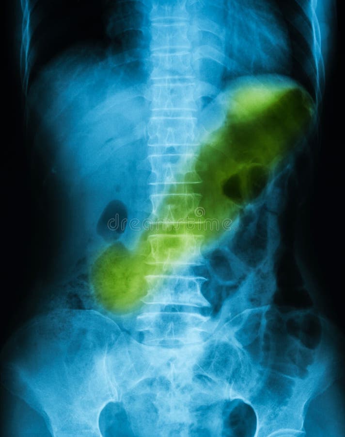 X-ray Image of Plain Abdomen Supine. Stock Photo - Image of extremity ...