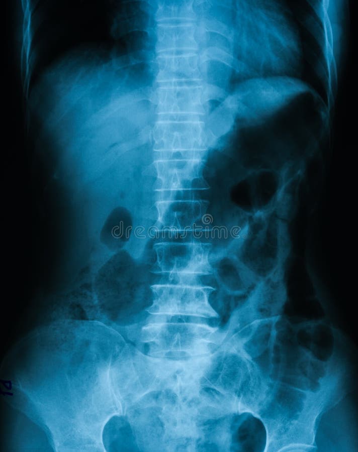 X-ray Image of Plain Abdomen. Stock Photo - Image of ascending ...