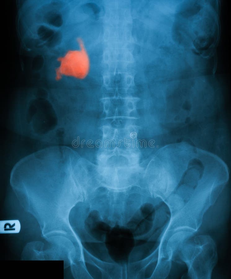 X-ray image of plain KUB. stock image. Image of doctor - 53839043