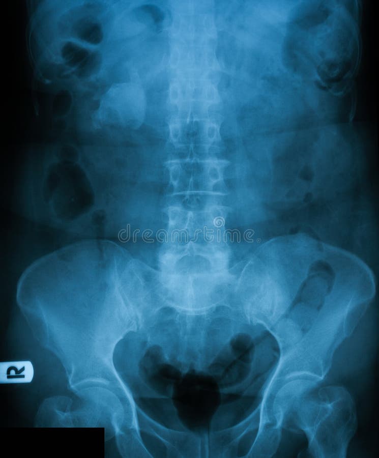X-ray image of plain KUB. stock image. Image of chronic - 53839255