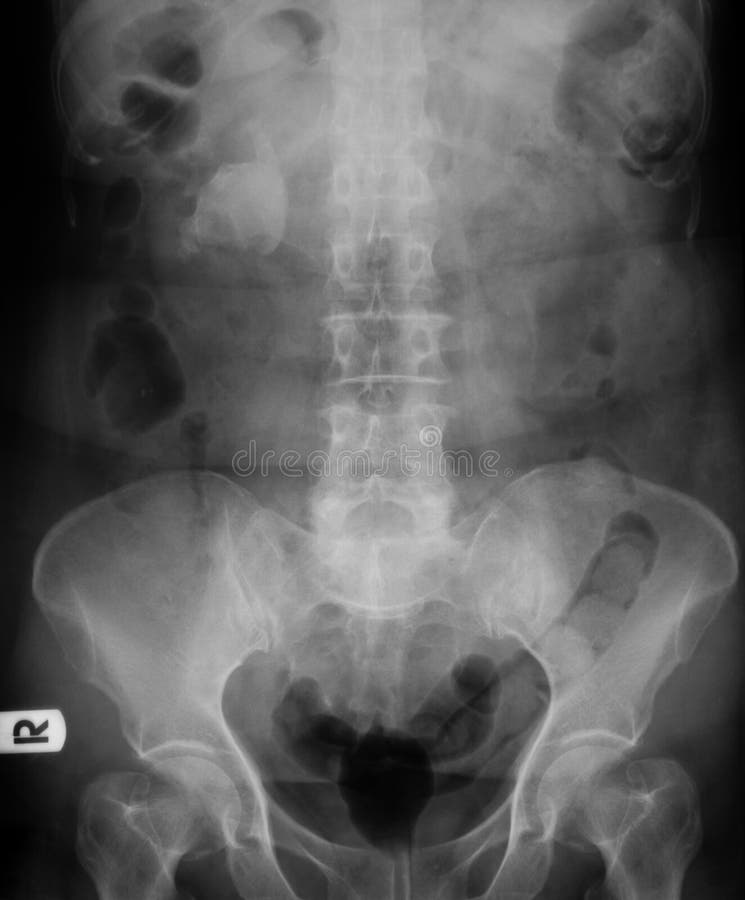 X-ray image of plain KUB. stock photo. Image of bladder - 53838892