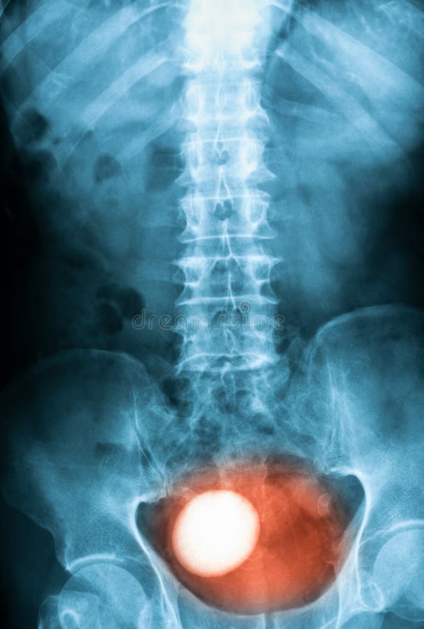X-ray Image of Plan KUB(Kidney,Ureter and Bladder), Supine View Stock ...
