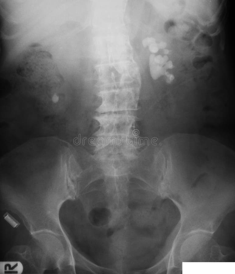 X-ray Image of Plan KUB(Kidney,Ureter and Bladder), Supine View Stock ...