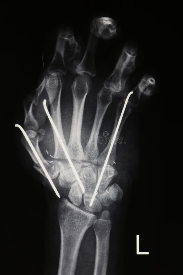 X-ray Image of Re-connected Hand Surgery Stock Image - Image of ...
