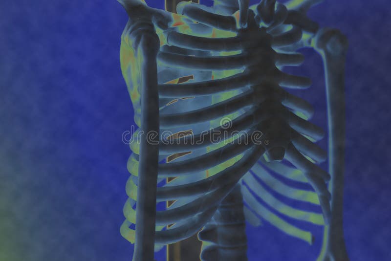 X-ray Image of the Rib of Man. Stock Image - Image of medical ...