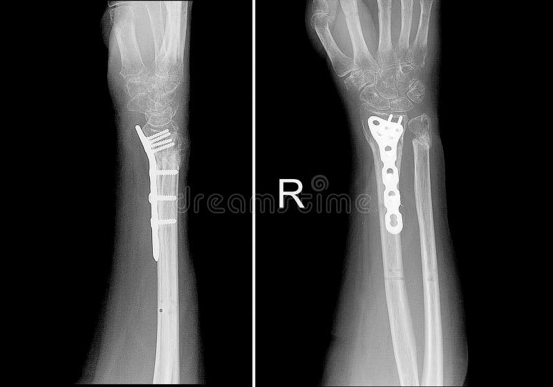 X-ray Image of the Right Hand the Fracture of the Radius with the ...