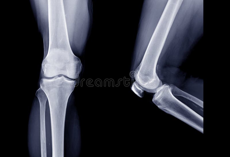 X-ray Image of Right Knee Joint AP View and Lateral View. Stock Image ...