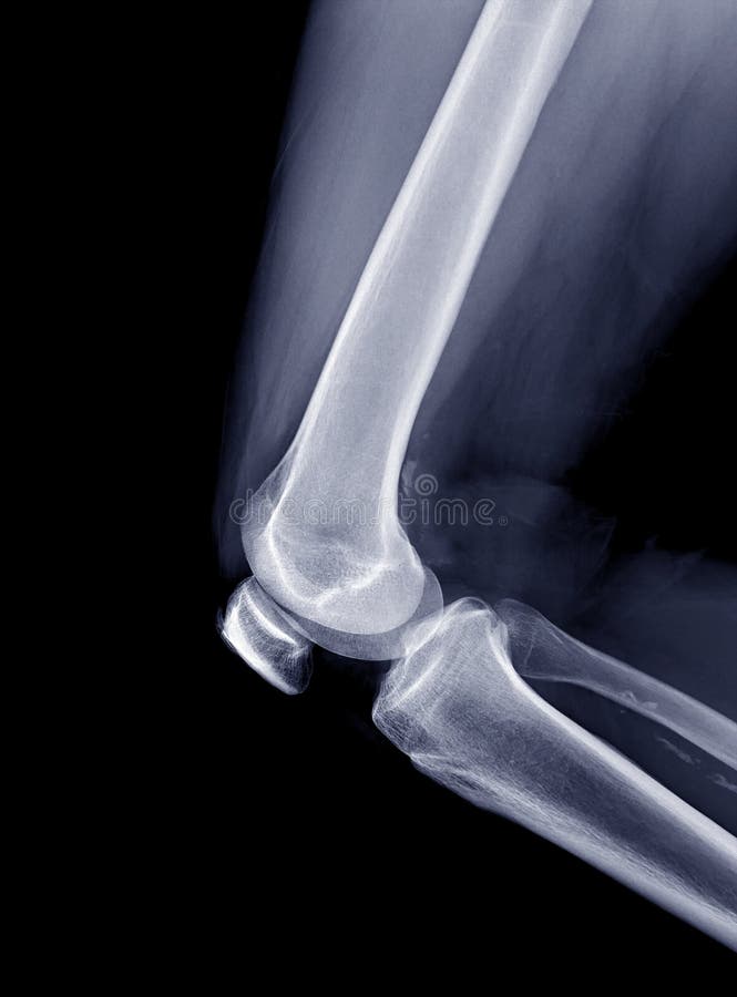 X-ray Image of Right Knee Joint AP View and Lateral View. Stock Image ...