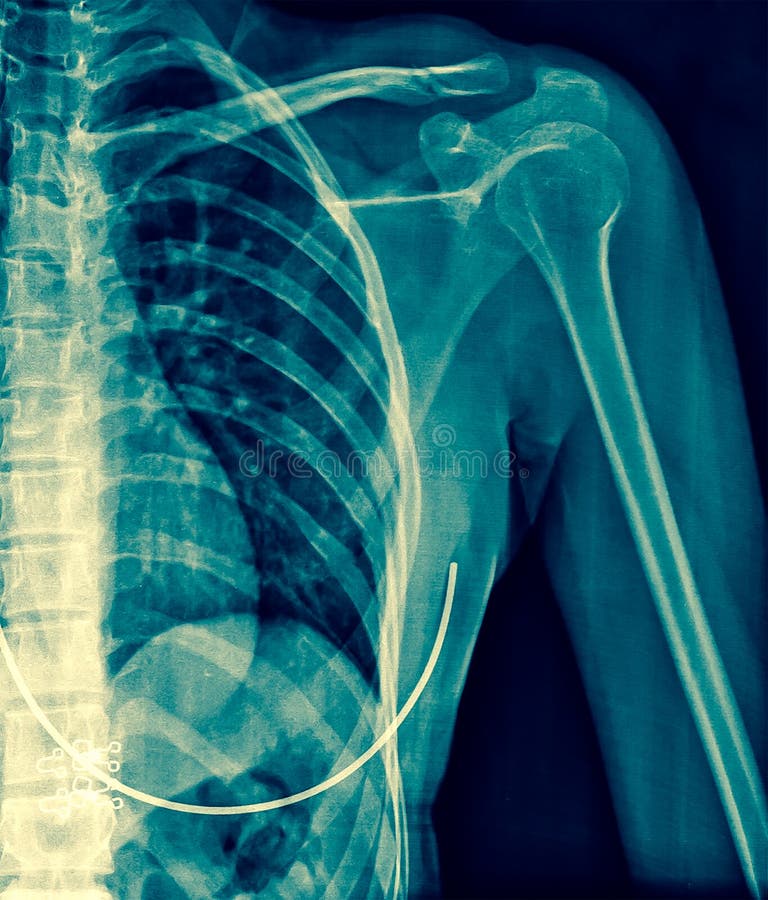 X-ray Image of Shoulder AP View Stock Photo - Image of radiography ...