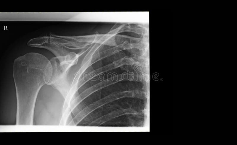 X-ray Image of a Shoulder Joint Stock Photo - Image of skeleton, people ...