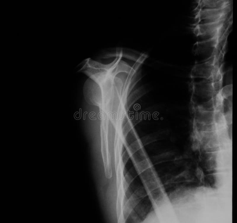 X-ray Image of Shoulder Joint. Stock Photo - Image of room, tissue ...