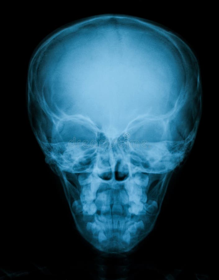 X-ray Image of Skull, AP View. Stock Photo - Image of dental, orbital ...