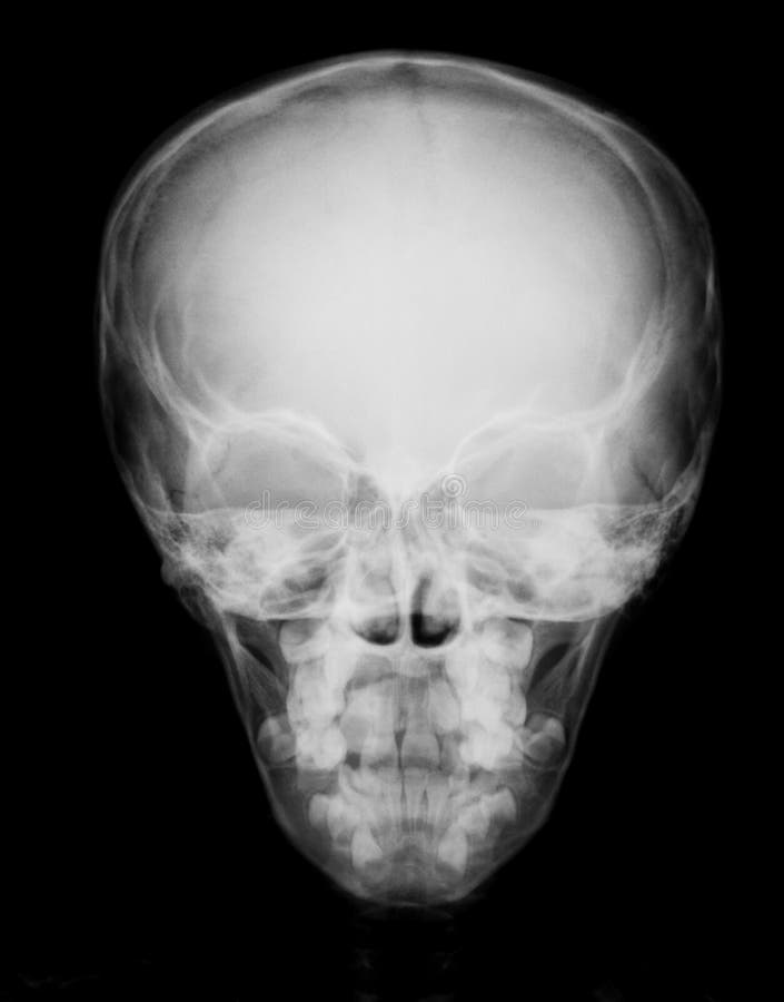 X-ray Image of Skull,PA View Stock Photo - Image of mandible, skull ...