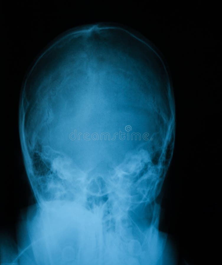 X-ray image of skull. stock image. Image of human, medicine - 54281767