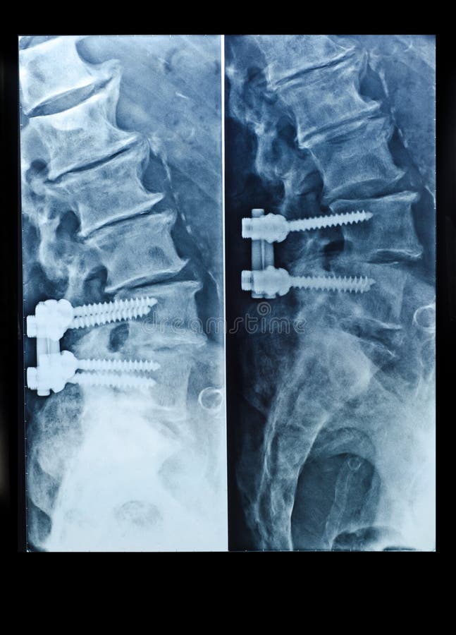 X-Ray Image of Spinal Column with Screws after Surgery Stock Photo ...