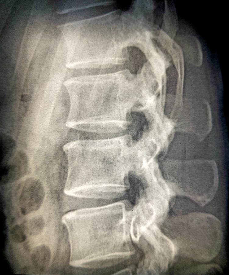 X-Ray Image of Human Spine, Back and Neck with Pain. Stock Image ...