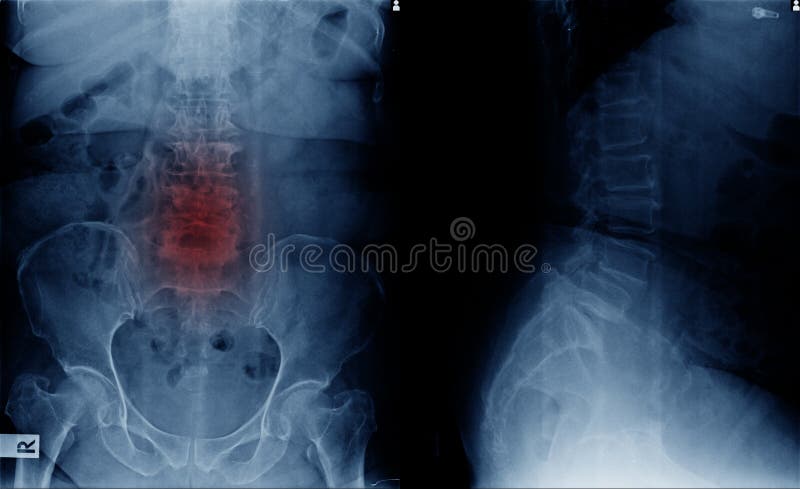 X-ray Image of L-S Spine, AP View. Stock Image - Image of muscle ...