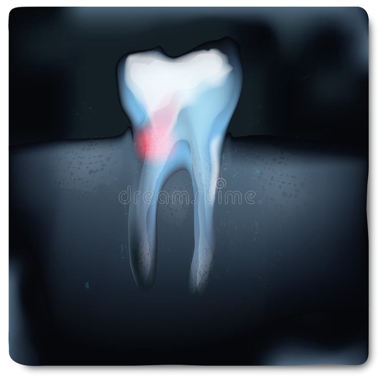 Tooth Pain Surgery Stock Illustrations – 1,645 Tooth Pain Surgery Stock ...