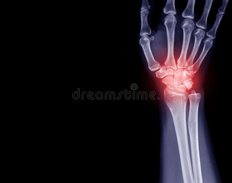 X-ray Image of Wrist Joint Front View of Normal Wrist Joint Stock Photo ...